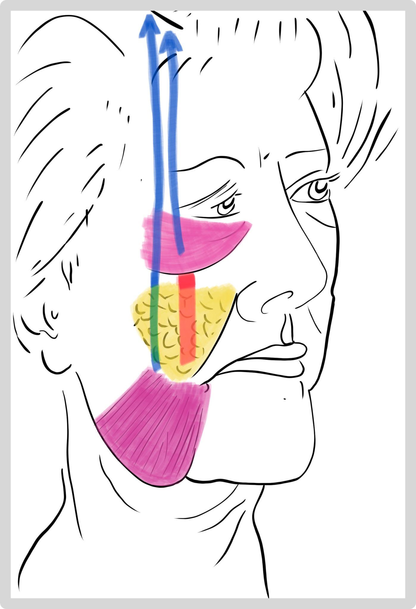 Midface Lift - Vertical Facelift Restore by Michael Byun MD