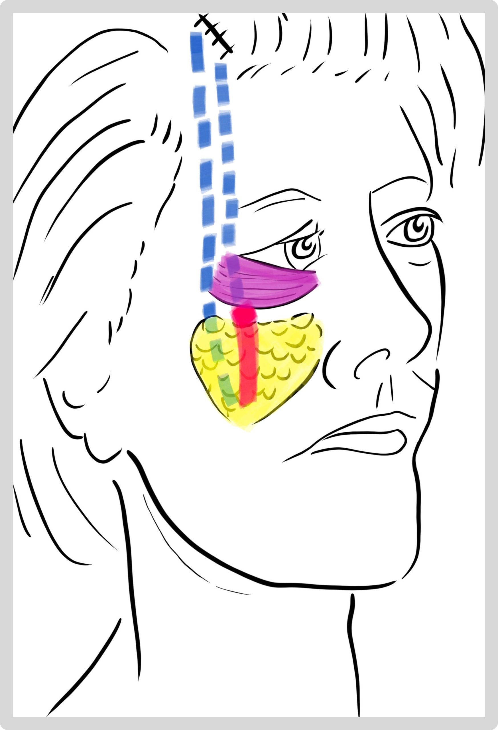 Face Lift Diagram at Dennis Raleigh blog
