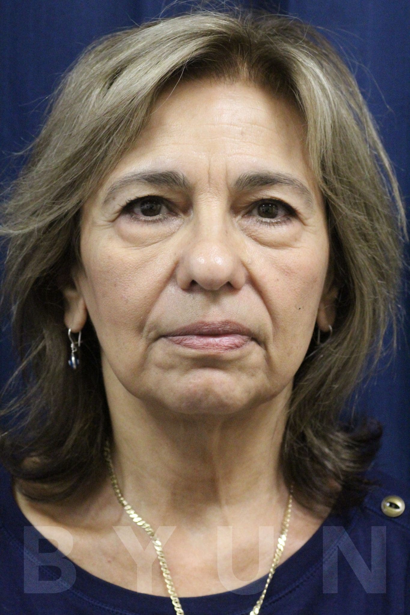 Cosmetic Surgery & Plastic Surgeon Chicago - Dr Michael BYUN