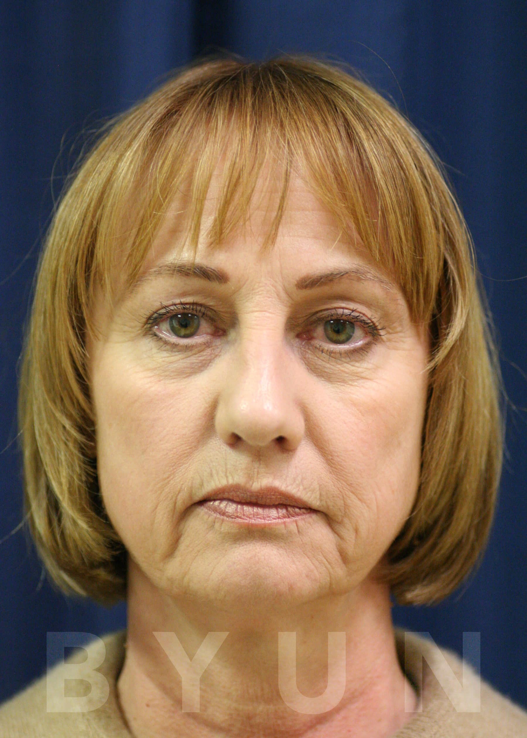 BYUN Techniques - Dr. Michael BYUN