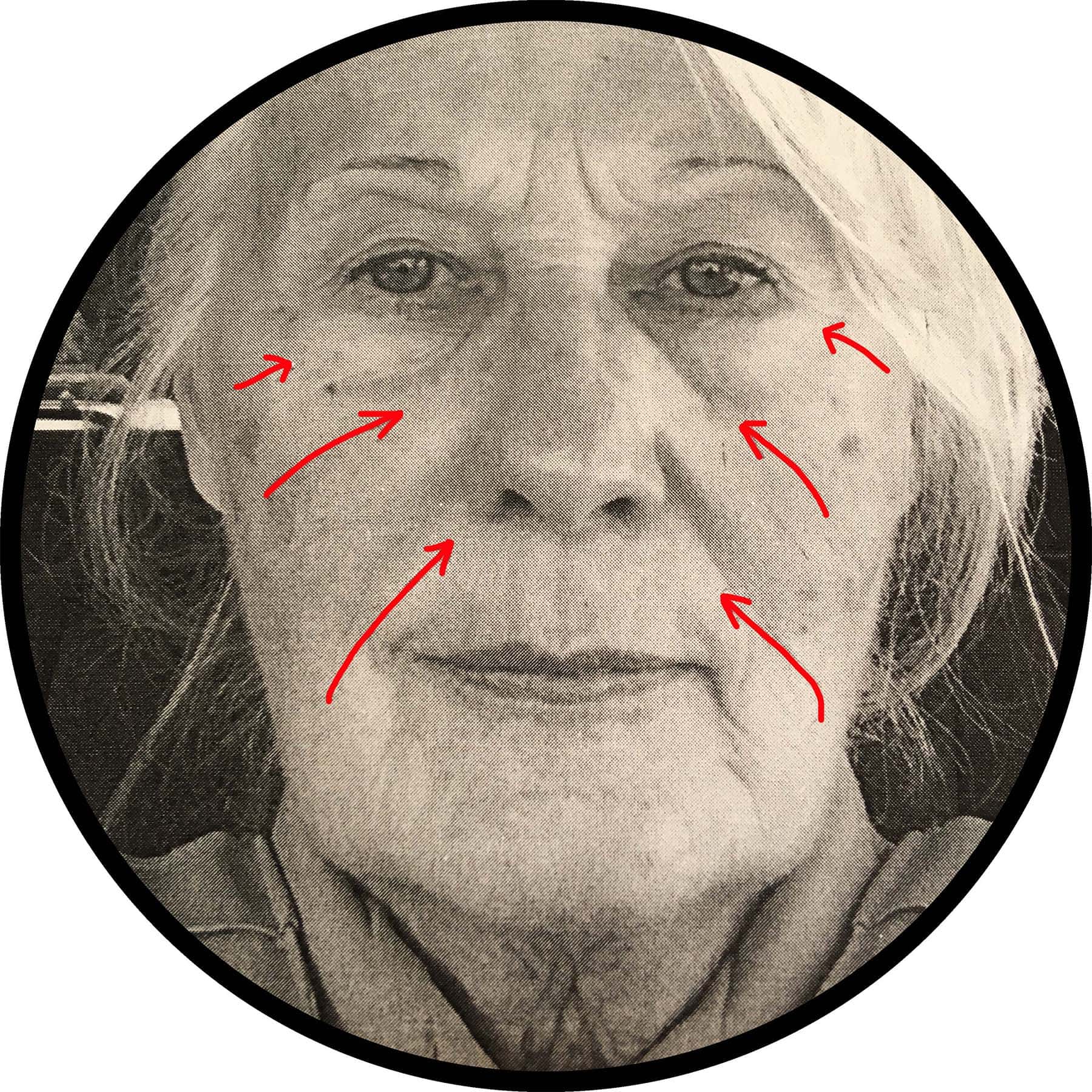 Midface Lift - Vertical Facelift Restore by Michael Byun MD