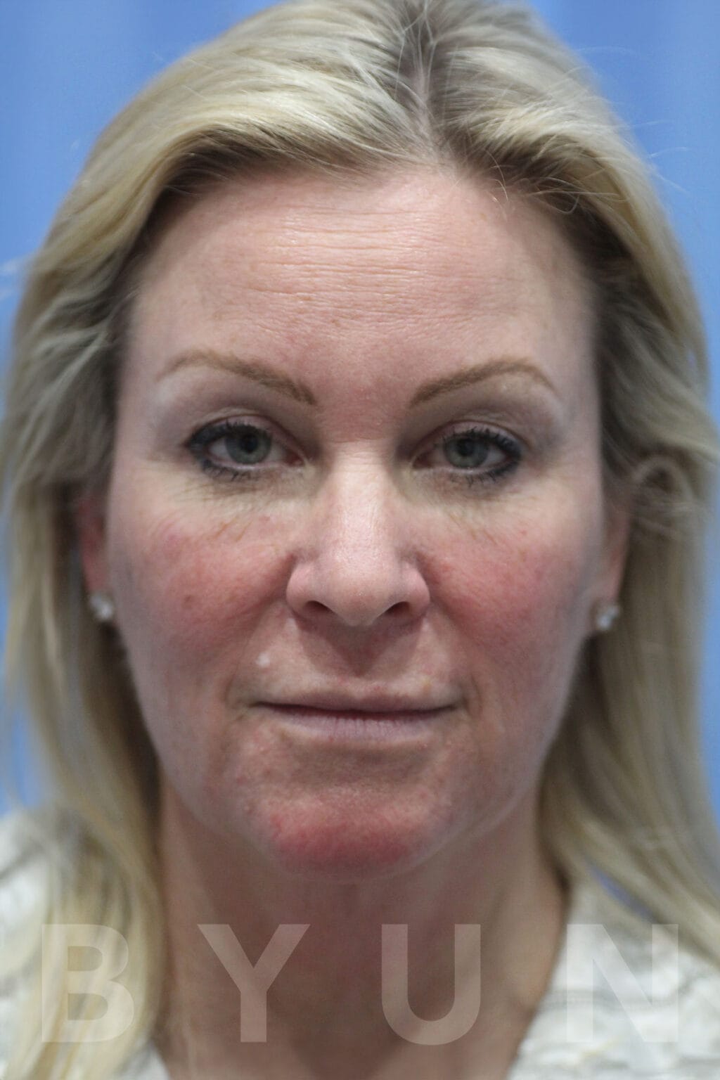 Cosmetic Surgery & Plastic Surgeon Chicago - Dr Michael BYUN